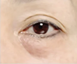 All About Eye-Bags — The Aesthetic Studio Singapore Clinic & Surgery