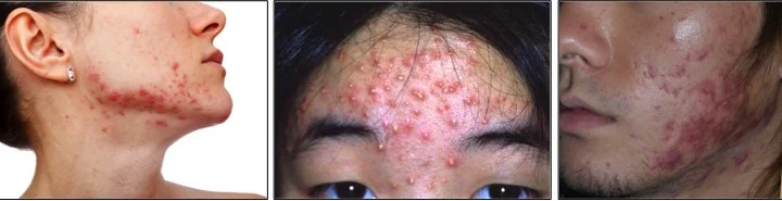 AGNES Radiofrequency Acne Treatment - Permanent Solution for Recurring ...