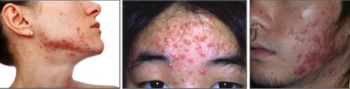 AGNES Radiofrequency Acne Treatment - Permanent Solution for Recurring ...