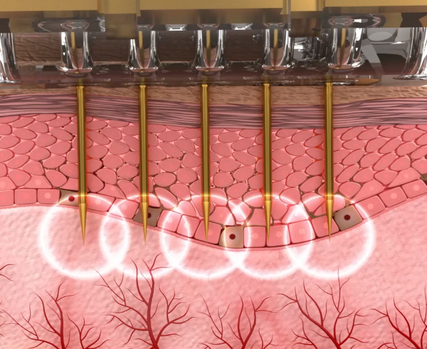 Sylfirm X - The World’s First Dual-Wave RF Microneedling System | The ...