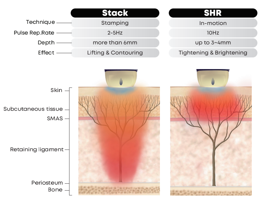 Soprano Titanium Lifting: The Treatment Korean Celebrities Swear By ...