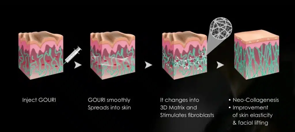 GOURI is the 1st liquid type PCL (Polycarprolactone) injectable - Zen ...