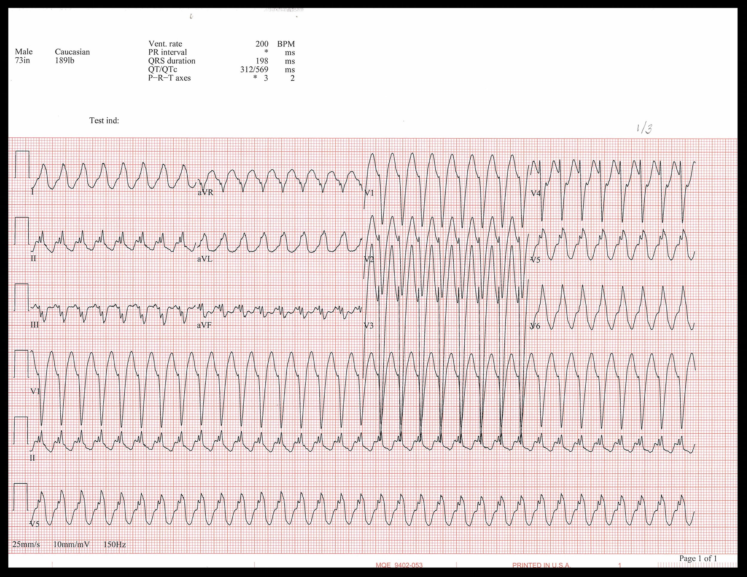 EKG of the Week — Inside the Silver Fridge