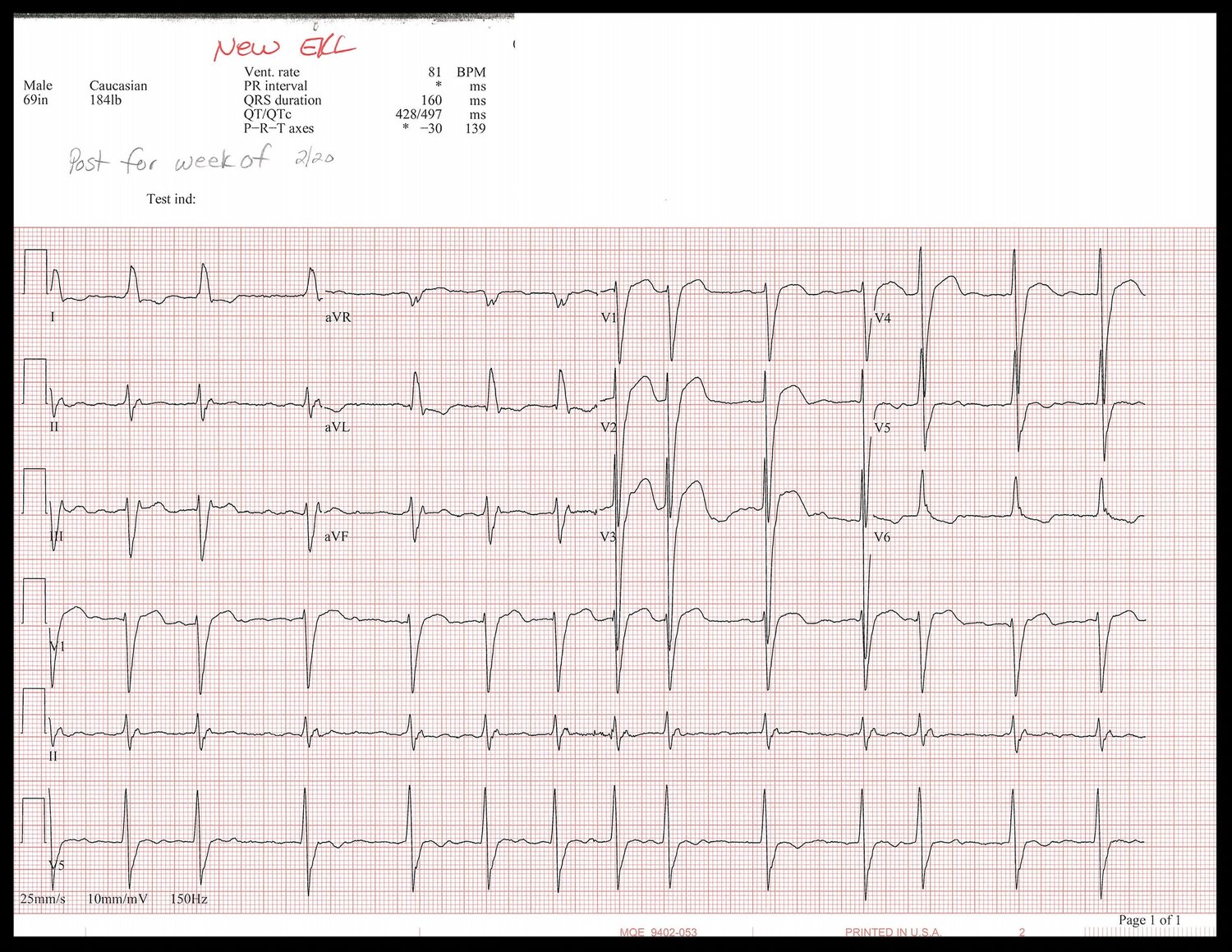 EKG of the Week — Inside the Silver Fridge