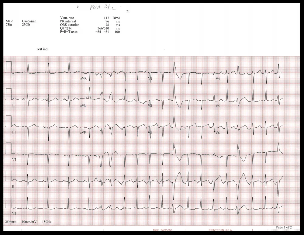 EKG of the Week — Inside the Silver Fridge