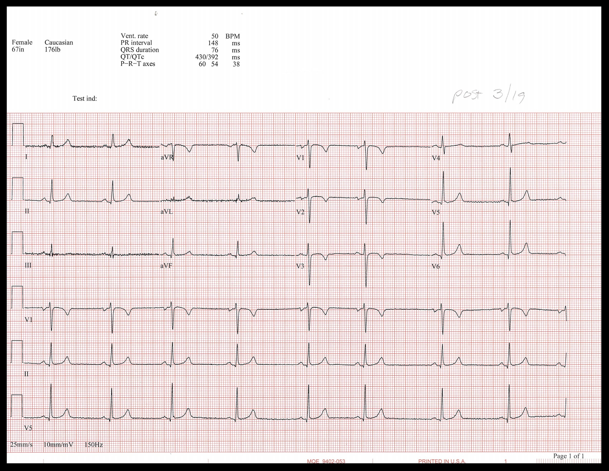 EKG of the Week — Inside the Silver Fridge