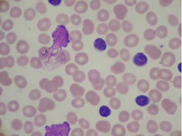 Smudge Cells in Chronic Lymphocytic Leukemia — Inside the Silver Fridge