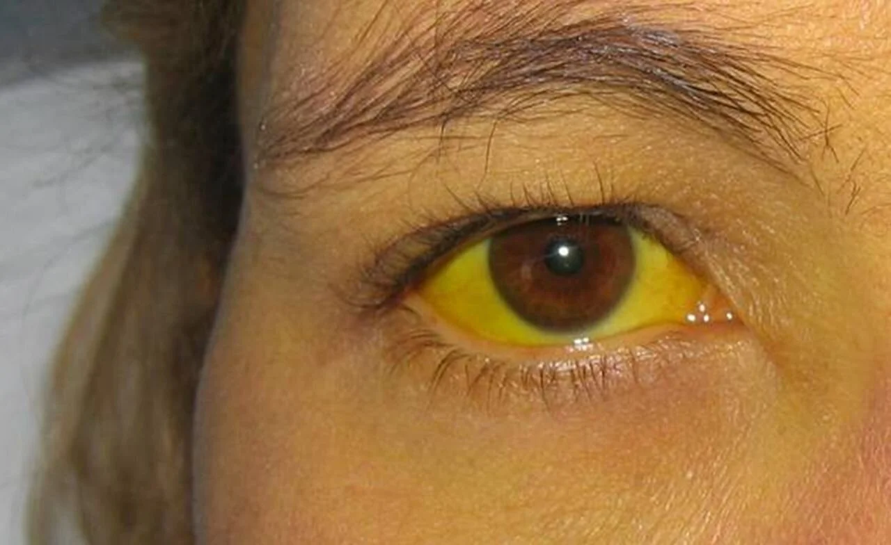 Scleral Icterus Treatment