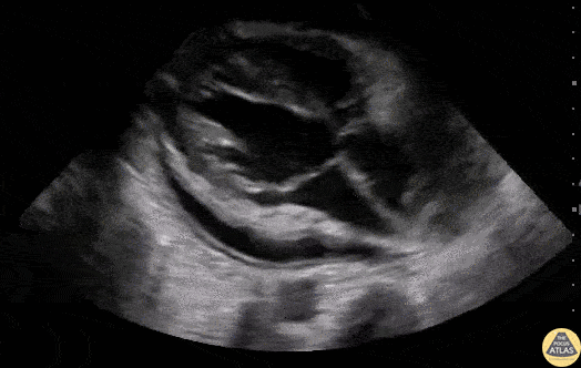 Cardiac Tamponade — Inside the Silver Fridge