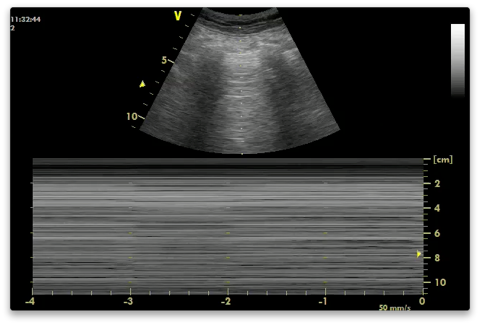 Pneumothorax POCUS — Inside the Silver Fridge