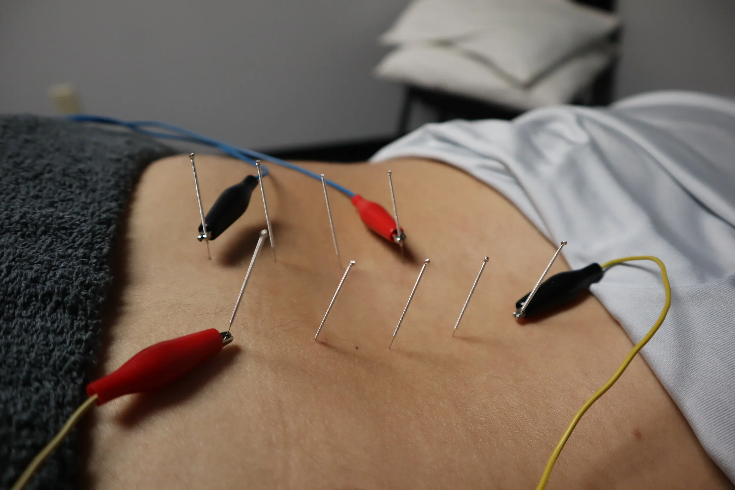 Trigger Points Needling – Trigger Point Technique – CDJF
