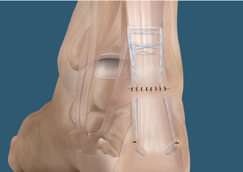 Achilles SpeedBridge™ Repair – Speeding Up the Return-to-Sport ...