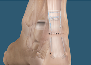 Achilles SpeedBridge™ Repair – Speeding Up the Return-to-Sport ...