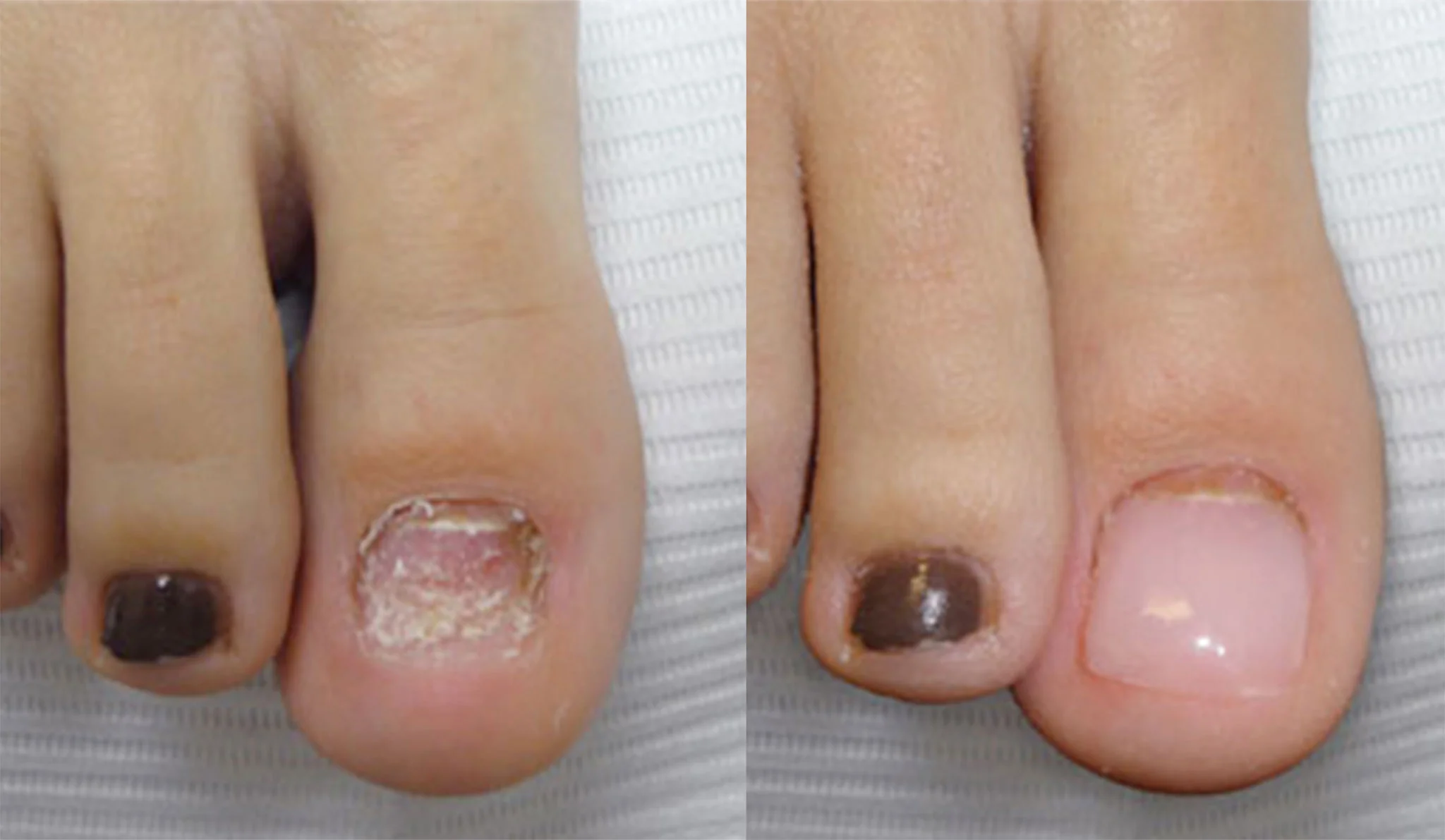 Keryflex Nail Restoration — Rose Bay Podiatry