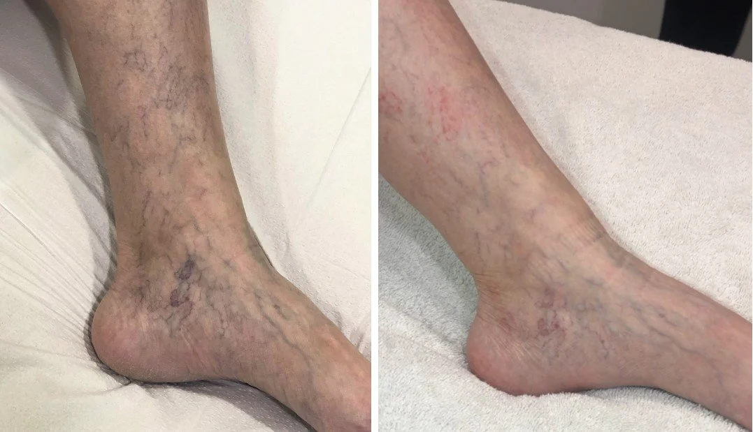 Vein Correction | Triton Vasculaze — Three Sisters Laser + Medical ...