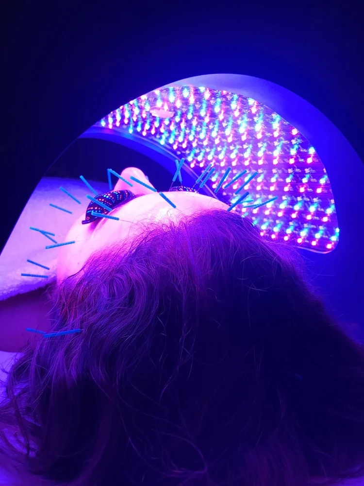 What Exactly Is Facial Acupuncture — And Why You Should Try It — Gotham ...