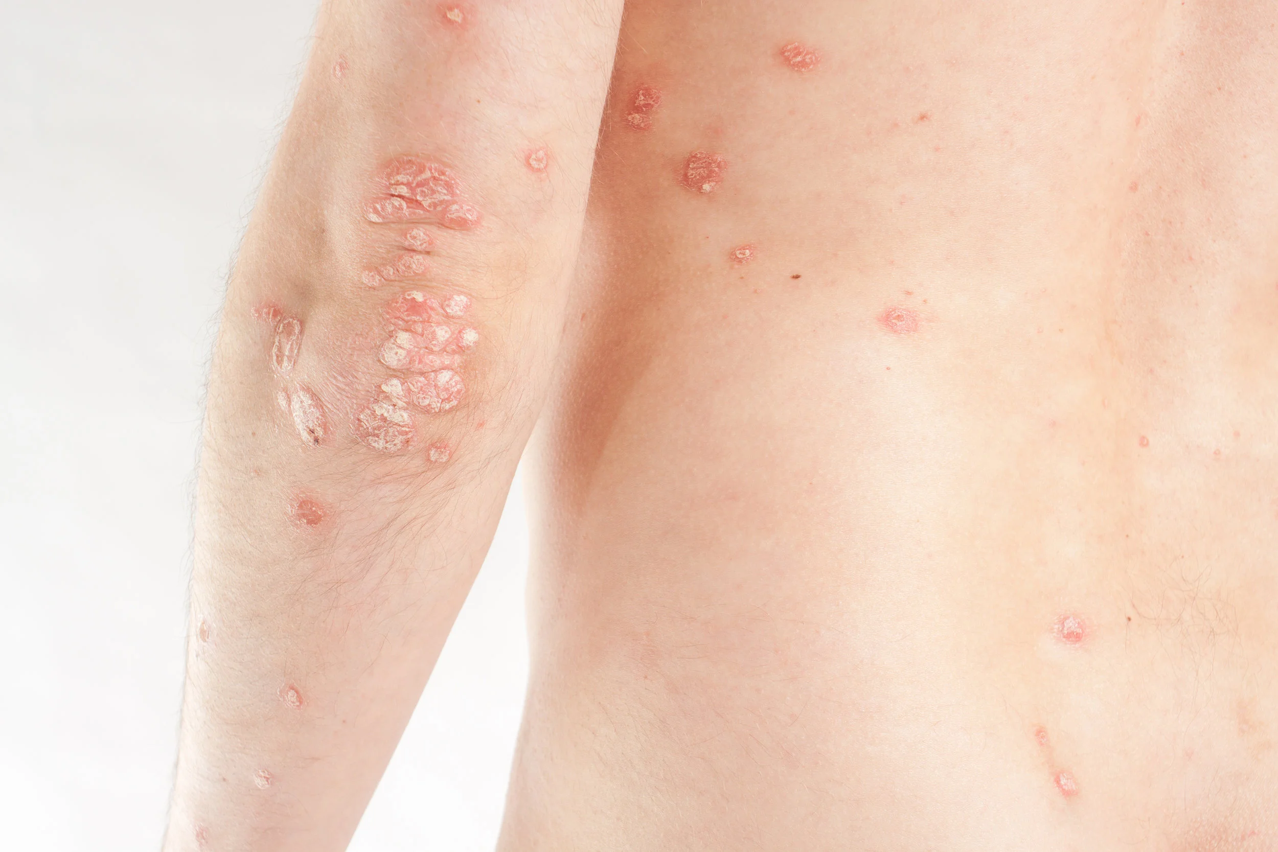 Hair Loss — Twin Cities Dermatology Center