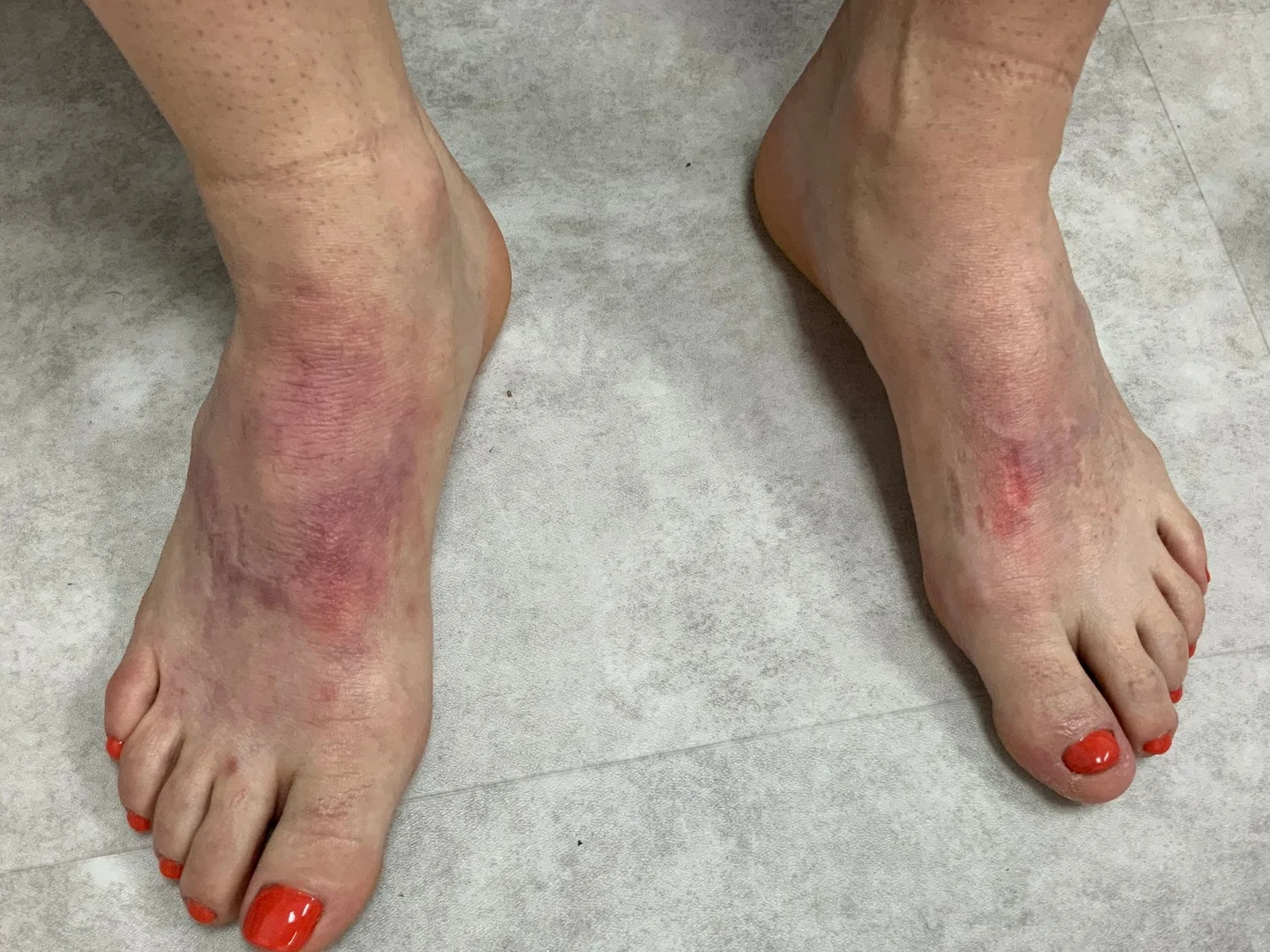 Eczema On Top Of Feet