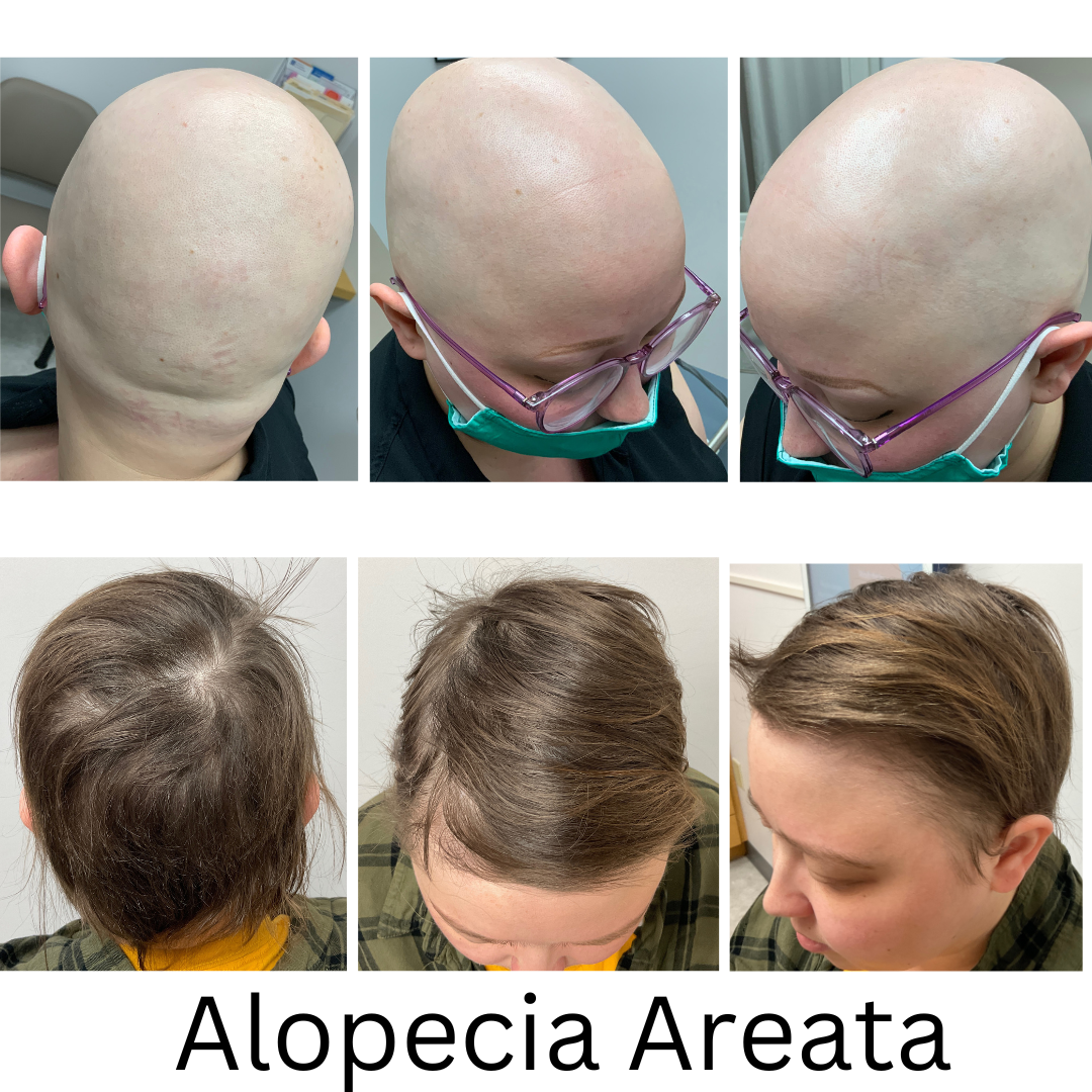 Hair Loss — Twin Cities Dermatology Center