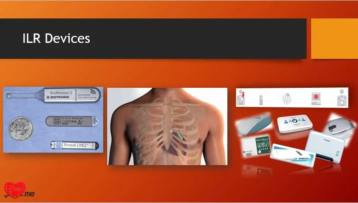 Episode 2: Using Implantable Loop Recorders (ILR) For Arrhythmia ...