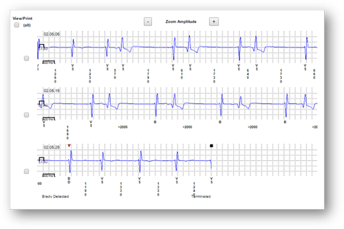 Episode 2: Using Implantable Loop Recorders (ILR) For Arrhythmia ...