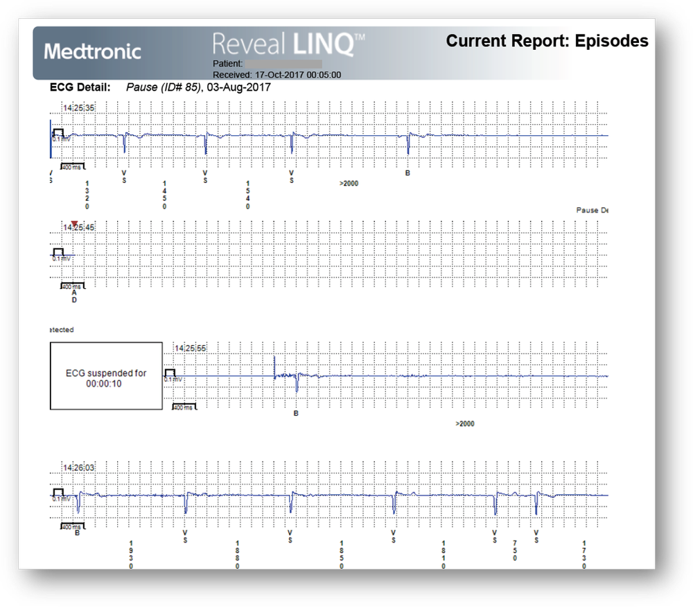 Episode 2: Using Implantable Loop Recorders (ILR) For Arrhythmia ...