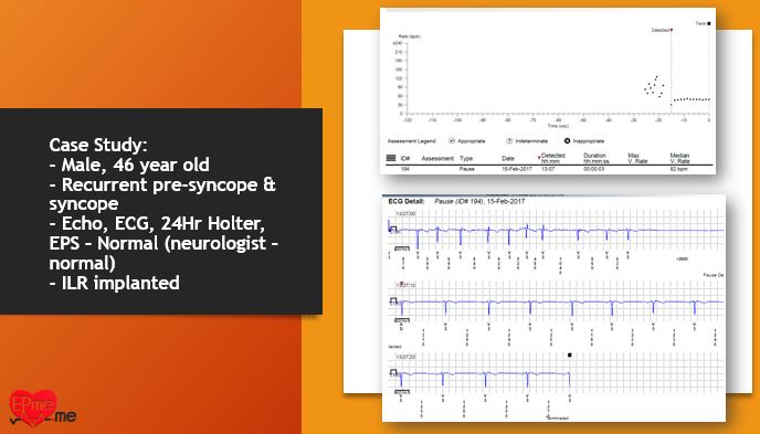 Episode 2: Using Implantable Loop Recorders (ILR) For Arrhythmia ...