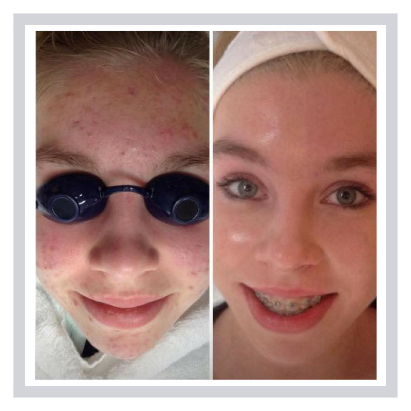 Best Acne Clinic | Spa Kingston San Diego — Spa Kingston