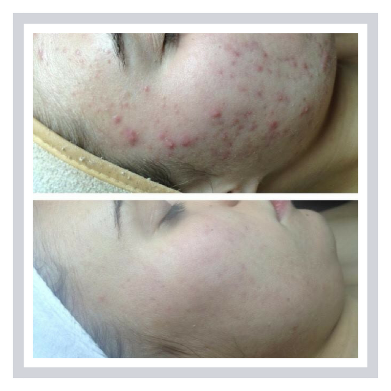 Best Acne Clinic | Spa Kingston San Diego — Spa Kingston