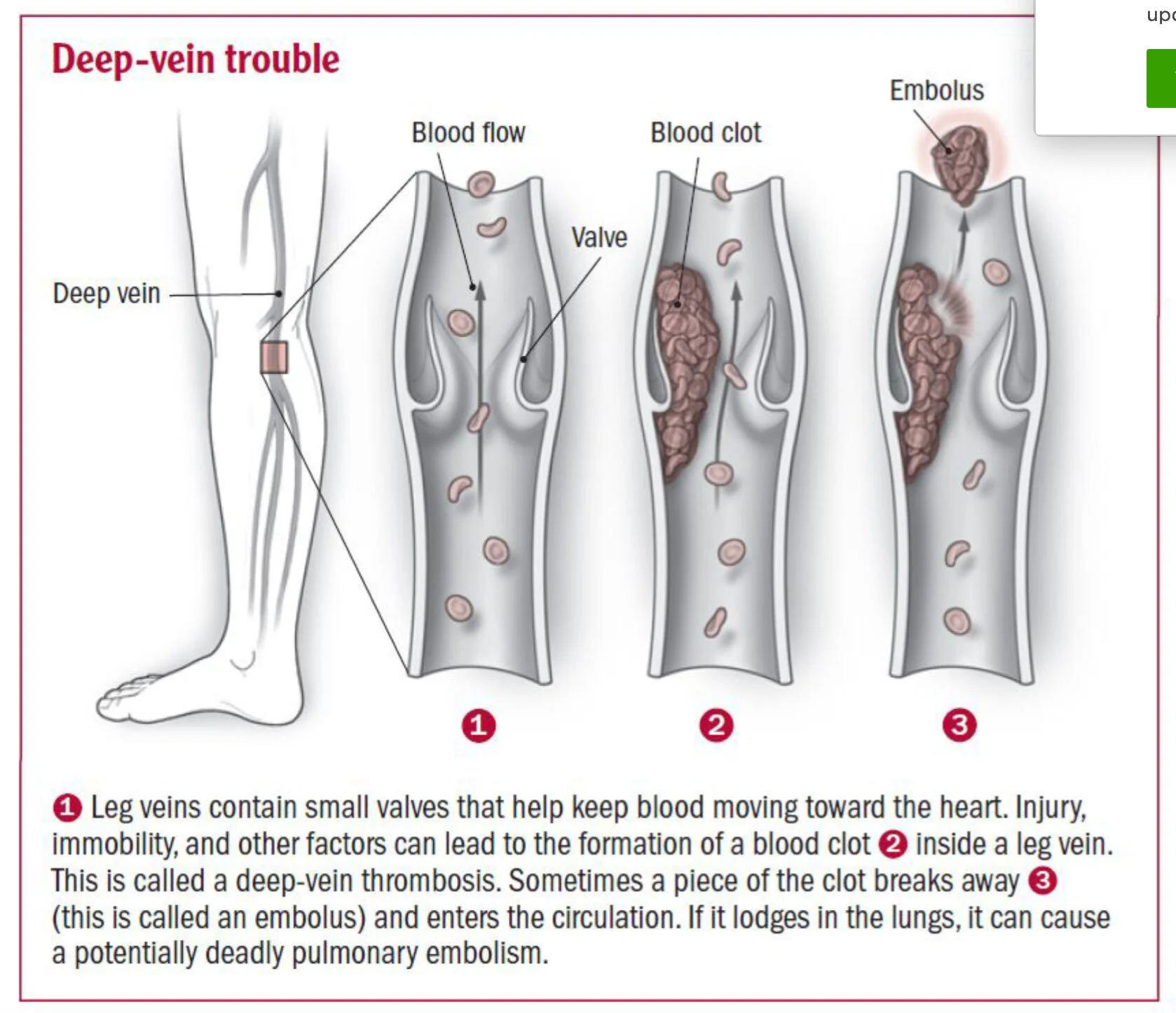 Is Calf Pain Normal After Acl Surgery Healing Picks Is Calf Pain Normal After Acl Surgery Healing Picks