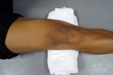 A Guide to Early ACL Rehabilitation