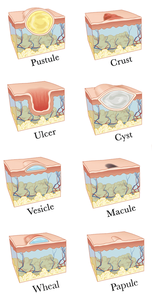 Let's Talk Lesions — Retief Skin Center | Nashville's Best ...