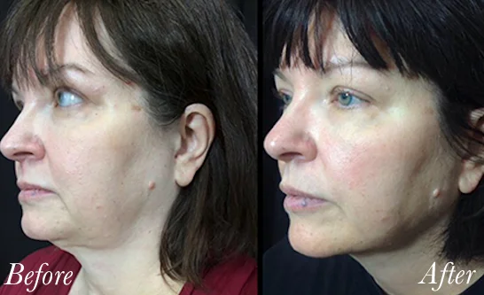 Facetite - Before & After Photos — Retief Skin Center | Nashville's ...