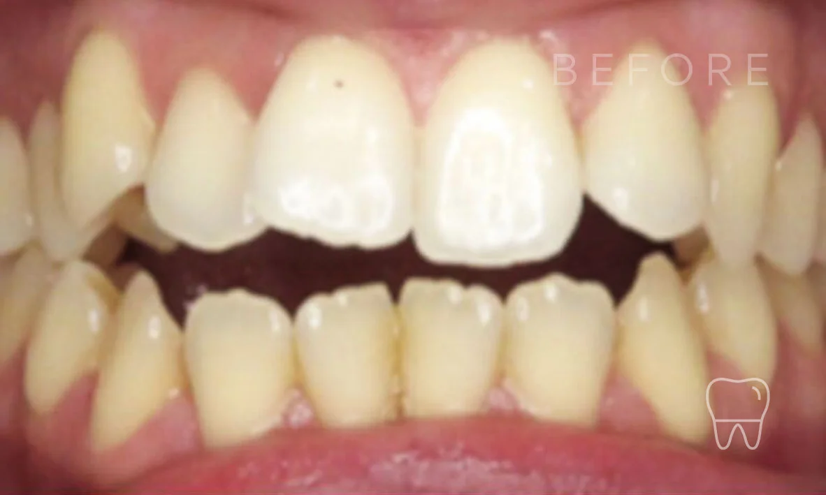 Myobrace — Clear Braces Sydney