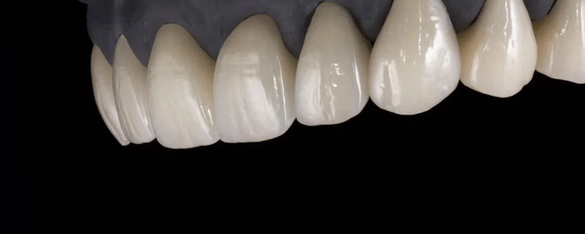 Fusion Teeth
