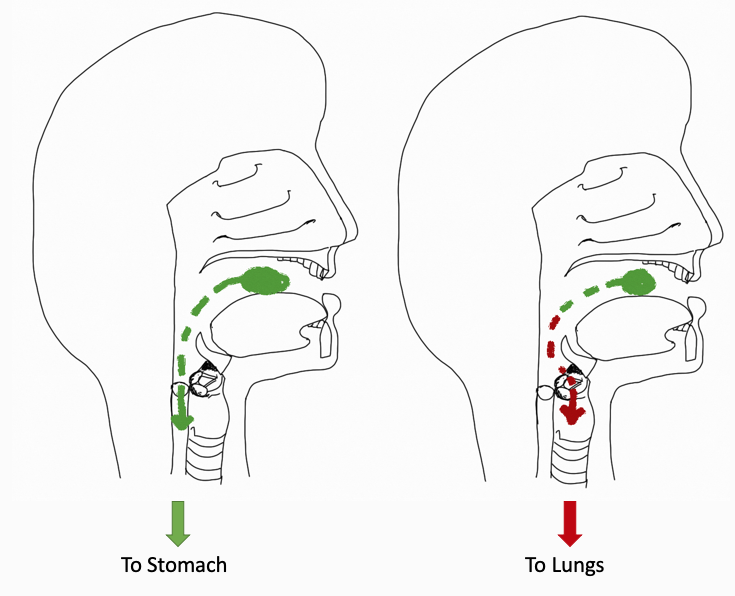 Causes Of Food Aspiration