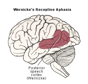 What are the symptoms of Wernicke’s aphasia? — Brain Stuff