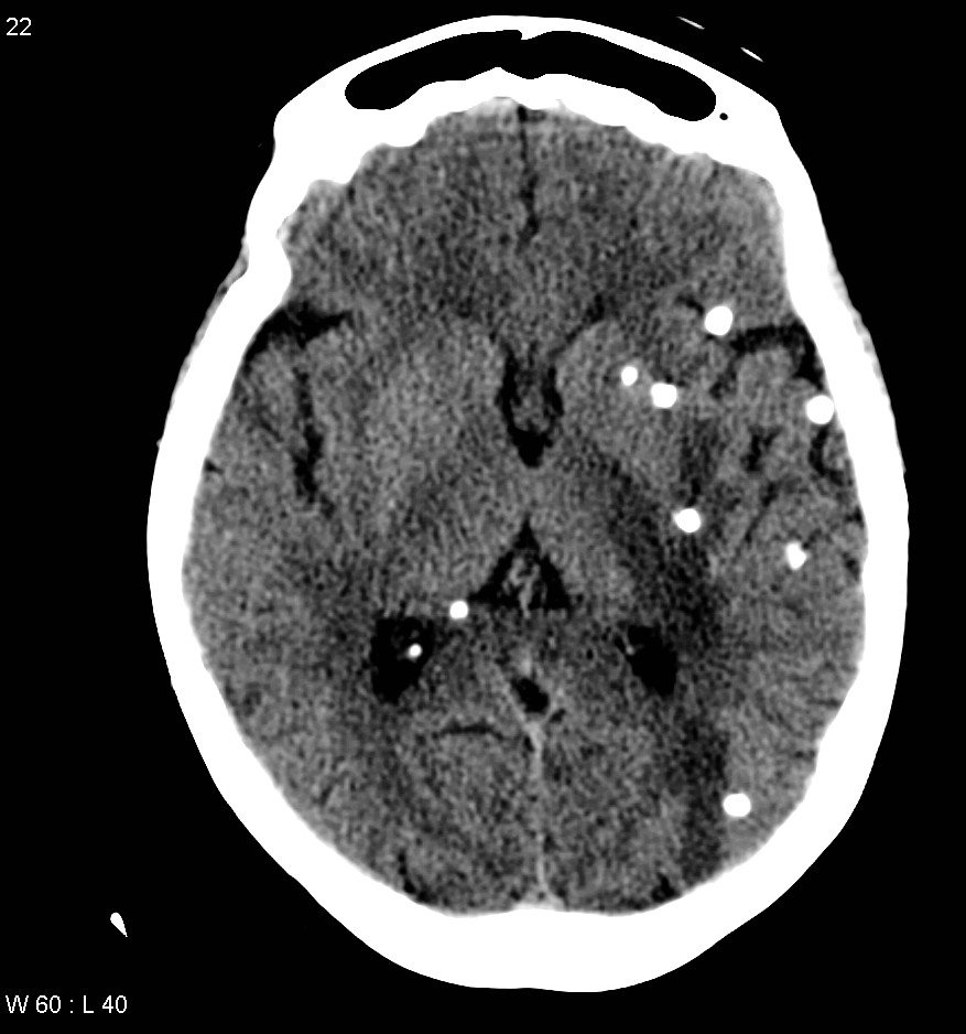 What Is The Insula — Brain Stuff