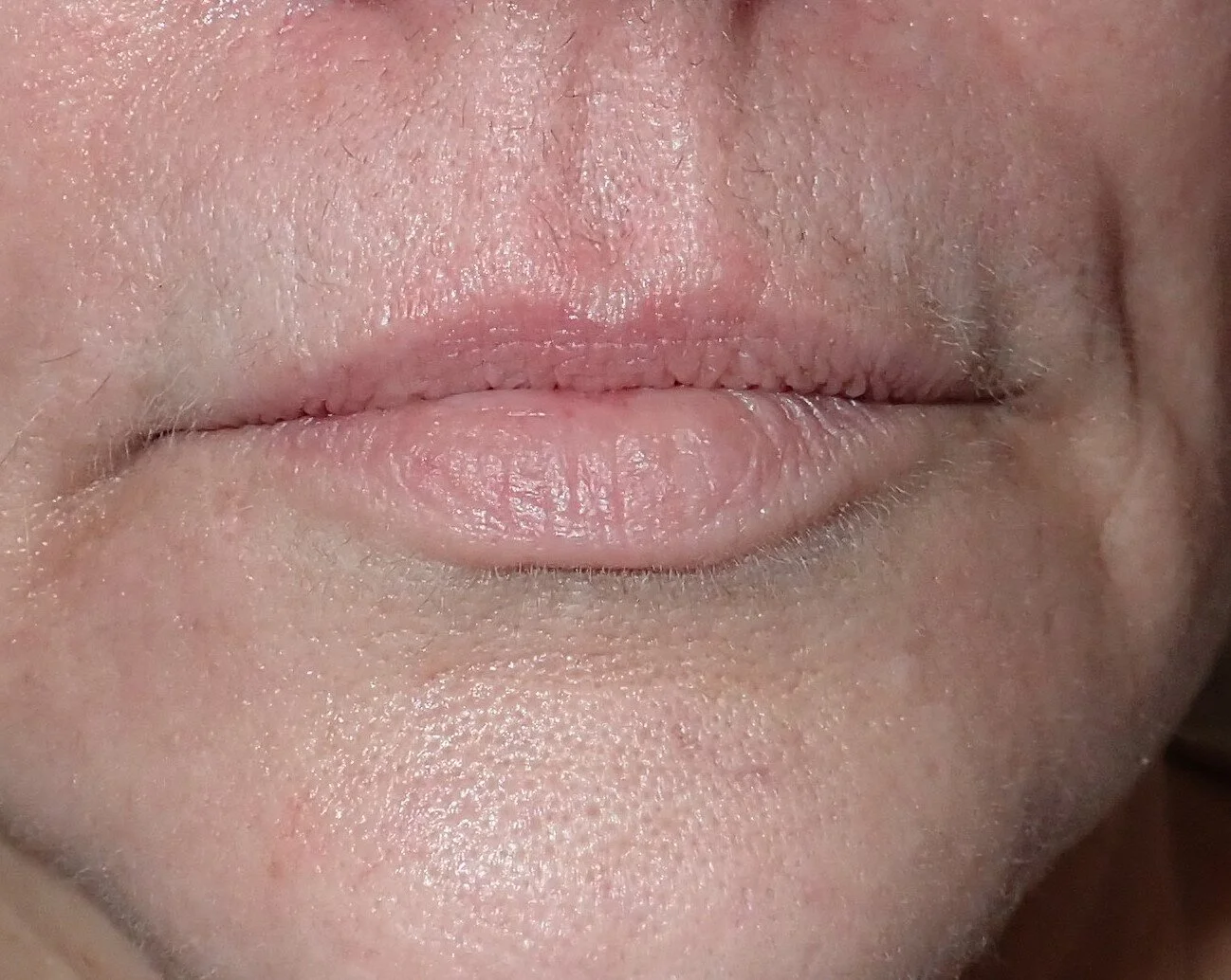 Before & After — HELIOS LASER CENTER