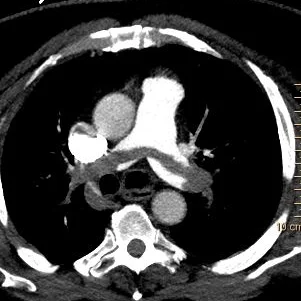 Saddle PE — Spectral CT