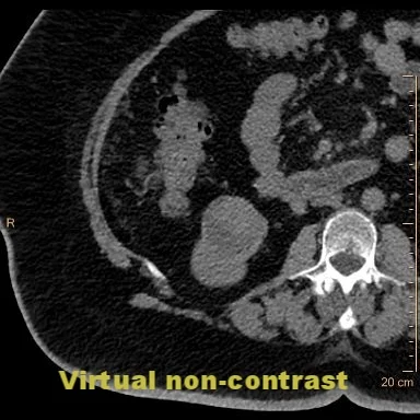 Complex kidney cyst — Spectral CT