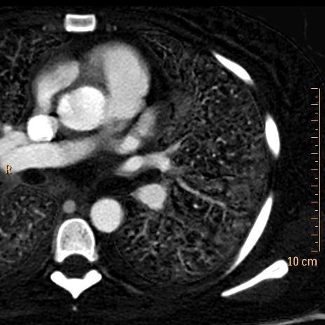 A case of a lung infiltrates — Spectral CT
