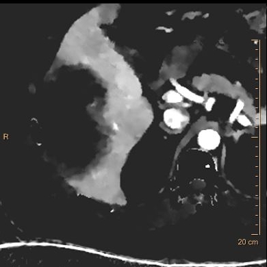 Liver abscess — Spectral CT