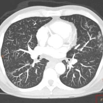 "Tree-in-bud" can mean tumor in bronchi too... — Spectral CT