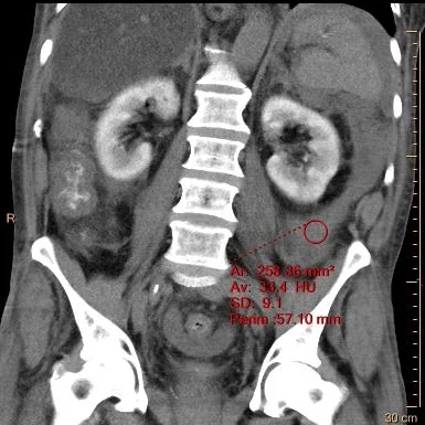 Hyperdense ascites — Spectral CT