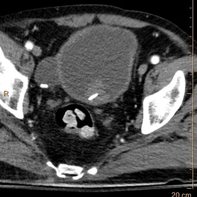 Painless hematuria — Spectral CT