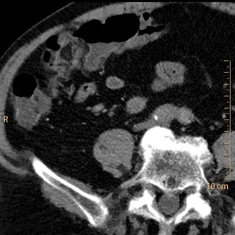 Goblet, anyone? — Spectral CT