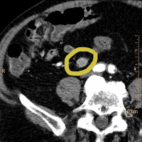 Goblet, anyone? — Spectral CT