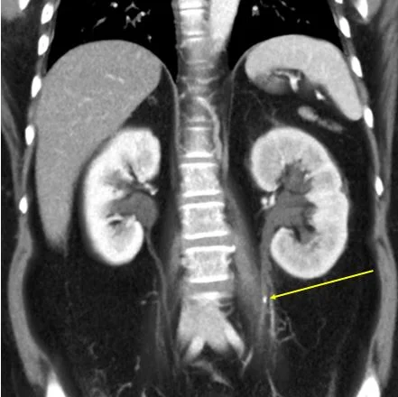 Urinary stone composition — Spectral CT