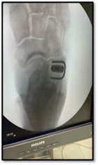 Evans Osteotomy Procedure — REIGN MEDICAL